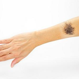 Show Their Scar Proudly MBTI Personality Type: ESTP